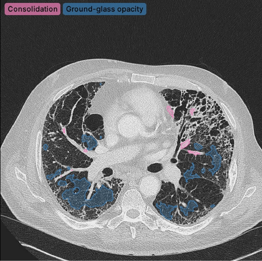 contextflow launches a new version of SEARCH Lung CT - contextflow