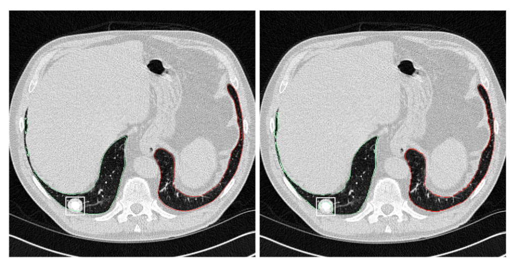 Improving Lung Segmentation For Higher Coverage Of Clinically Relevant